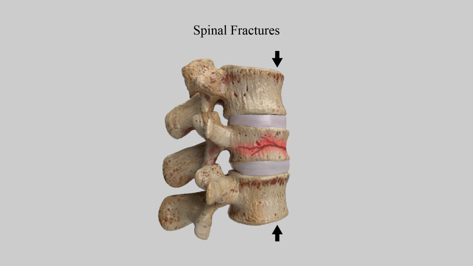 What You Need to Know About Spinal Fractures - Spine Doctor 33